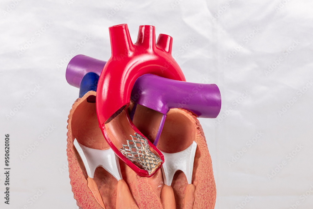 Cardiac model of Transcatheter aortic valve implantation (TAVI) for ...