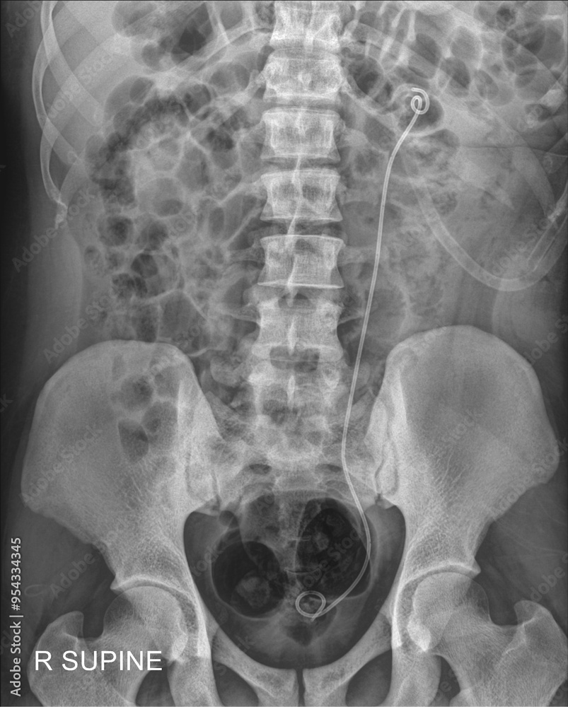 Urological X-ray Imaging: Comprehensive KUB Radiography with Stent ...