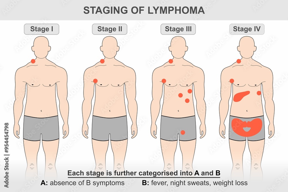 Poster Stages of Lymphoma signs and symptoms illustration – Muurposter | Europosters
