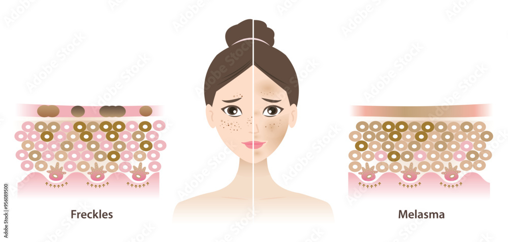 Infographic of freckles and melasma skin on woman face vector illustration. Comparison of ...