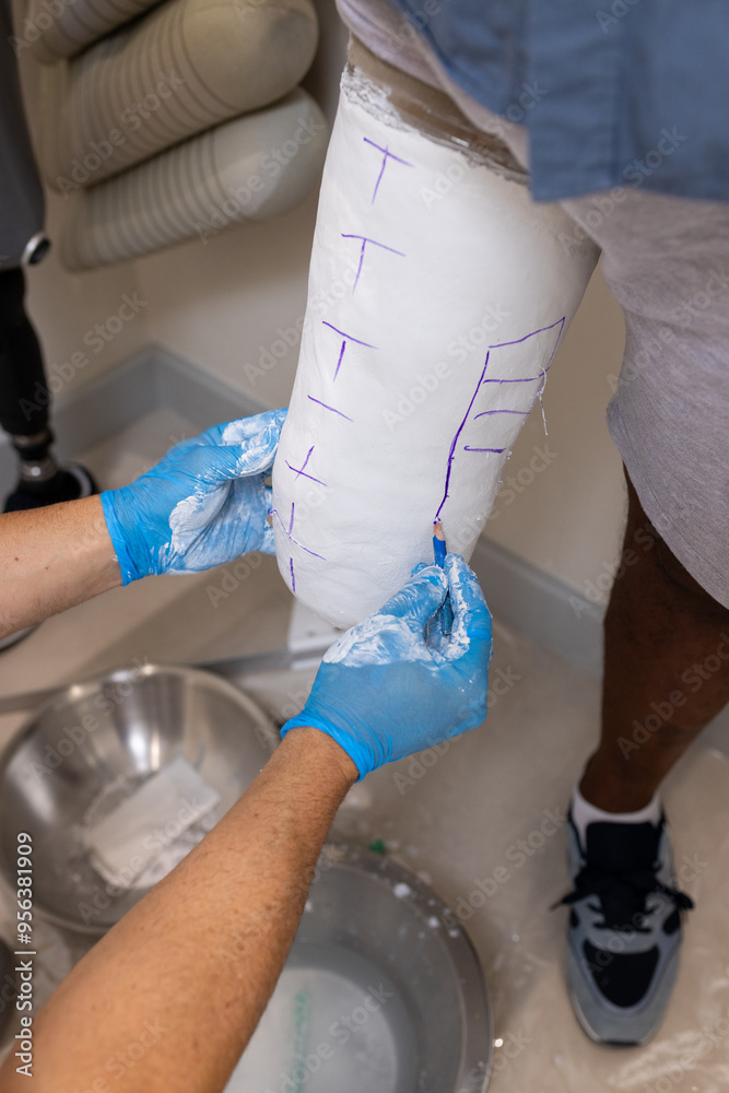 Creating custom prosthetic leg, technician marking plaster mold for ...