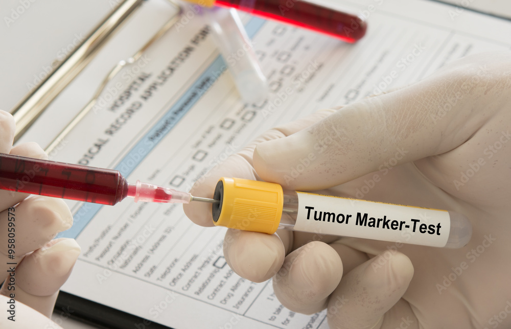 Tumor Marker Test concept. doctor uses a syringe blood sample into tube ...