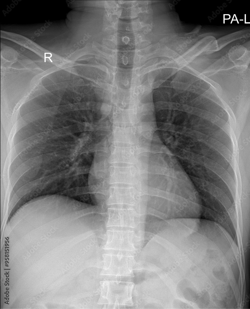 Thoracic Cavity X-Ray Explained: Insights into Your Chest Health Stock ...