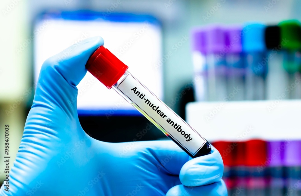 Blood sample tube for anti-nuclear antibody (ANA) test analysis. Stock ...
