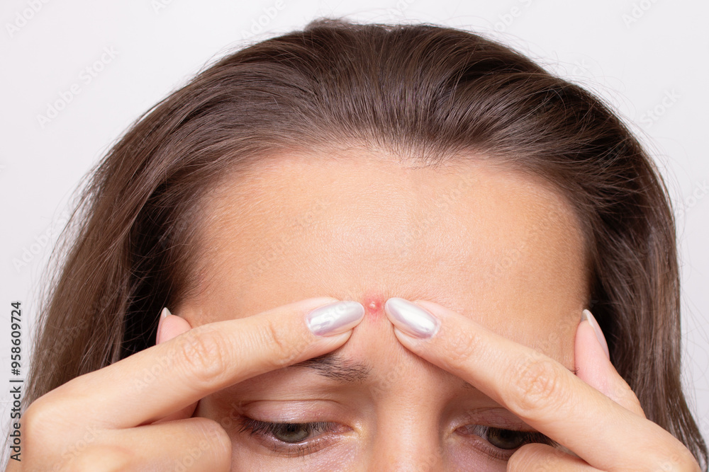 Young woman squeezes a big red inflamed pimple on her forehead, close ...