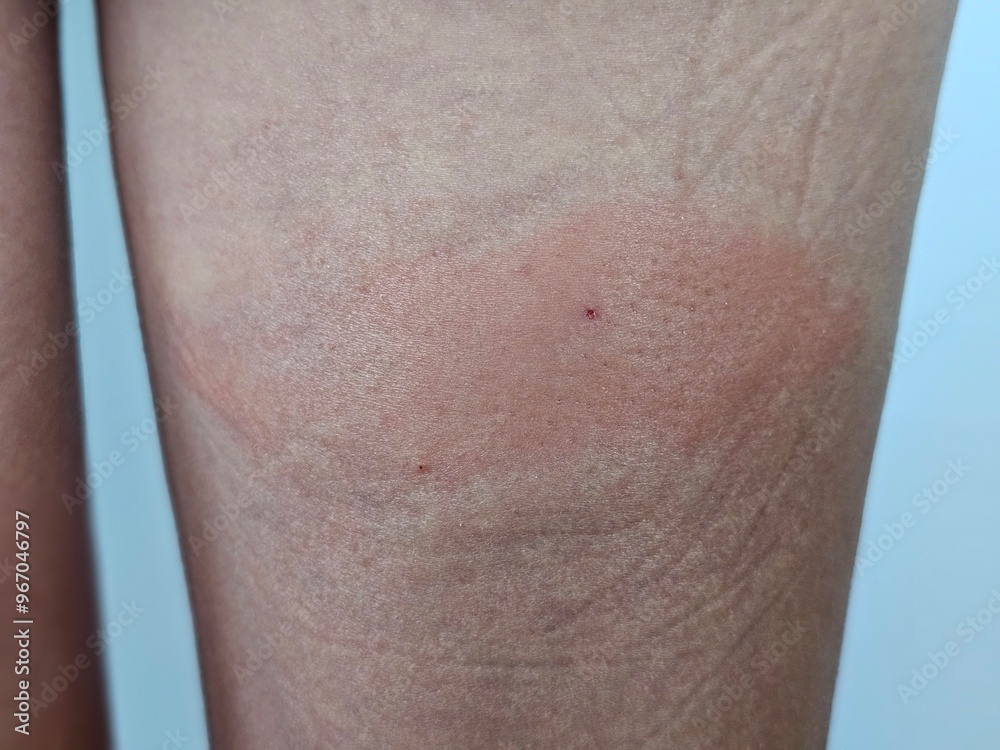 Swollen skin on the leg caused by an allergic reaction or an insect ...