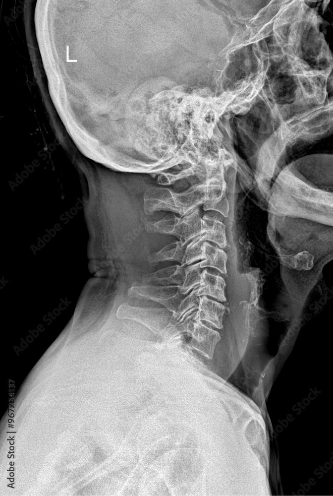 Lateral X-ray of the Neck: Cervical Vertebrae and Disc Spaces Stock ...