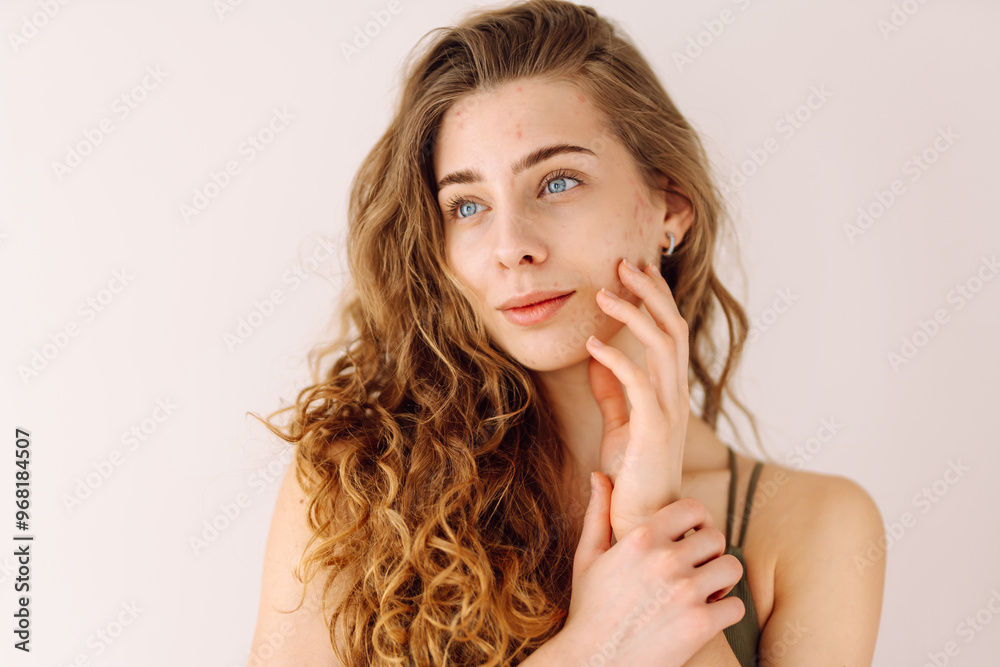 Beautiful young girl with problem skin. Young woman with wavy hair ...