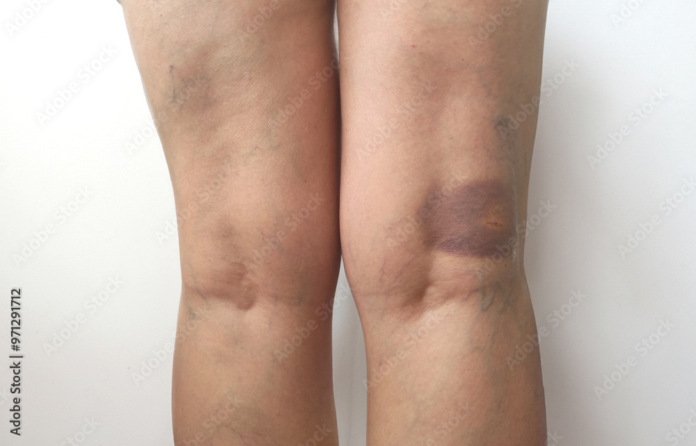 Close-up of a bruised kneecap with visible bruise and swelling. Bruises ...