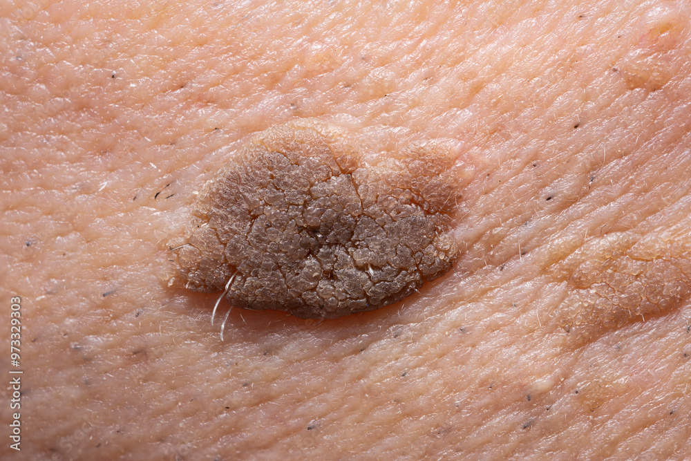 Close-Up of Brown Seborrheic Keratosis (Seborrhoeic wart, Basal cell ...