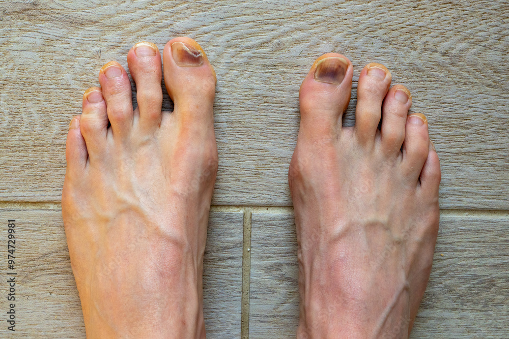 Runner's Feet: Black Toenails from Athletic Trauma. Barefoot Athlete's ...
