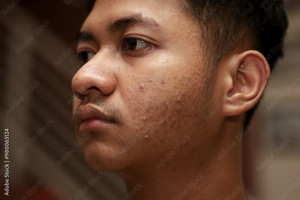 asian boy close up with pimples on cheeks due to allergies and excess ...