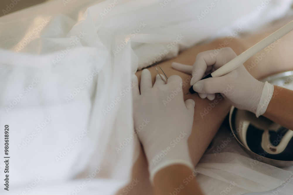 Surgeon gives injection of local anesthesia during laser removing mole ...