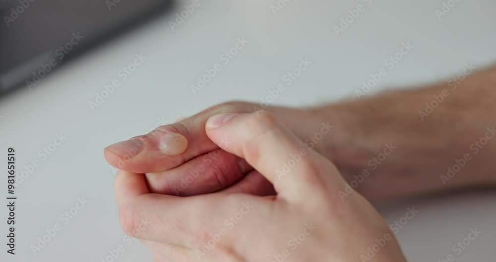 Hands, boil and dermatology with swelling, person and inflammation with ...