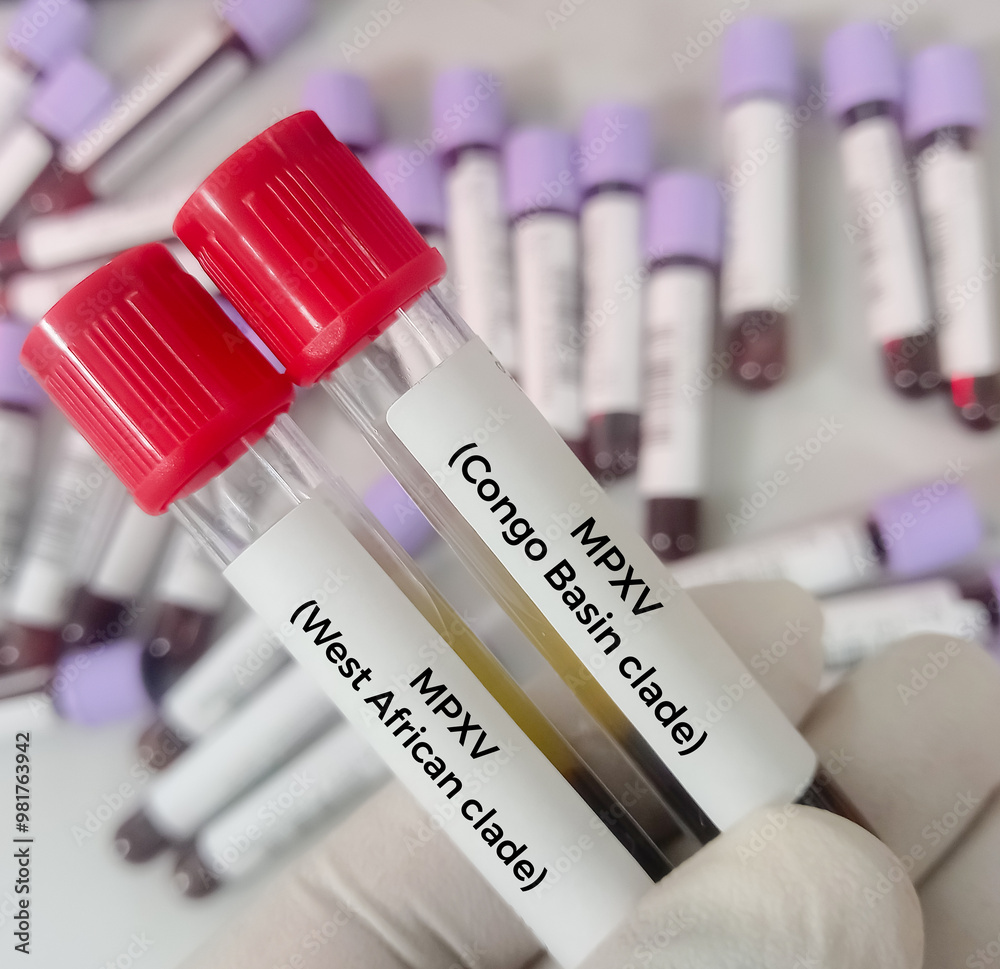 Blood sample for monkey pox virus (MPXV) test. Mpox (formerly known as ...