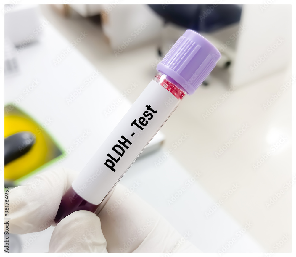Blood test sample for mRDT or malaria rapid diagnostic test. Histidine ...