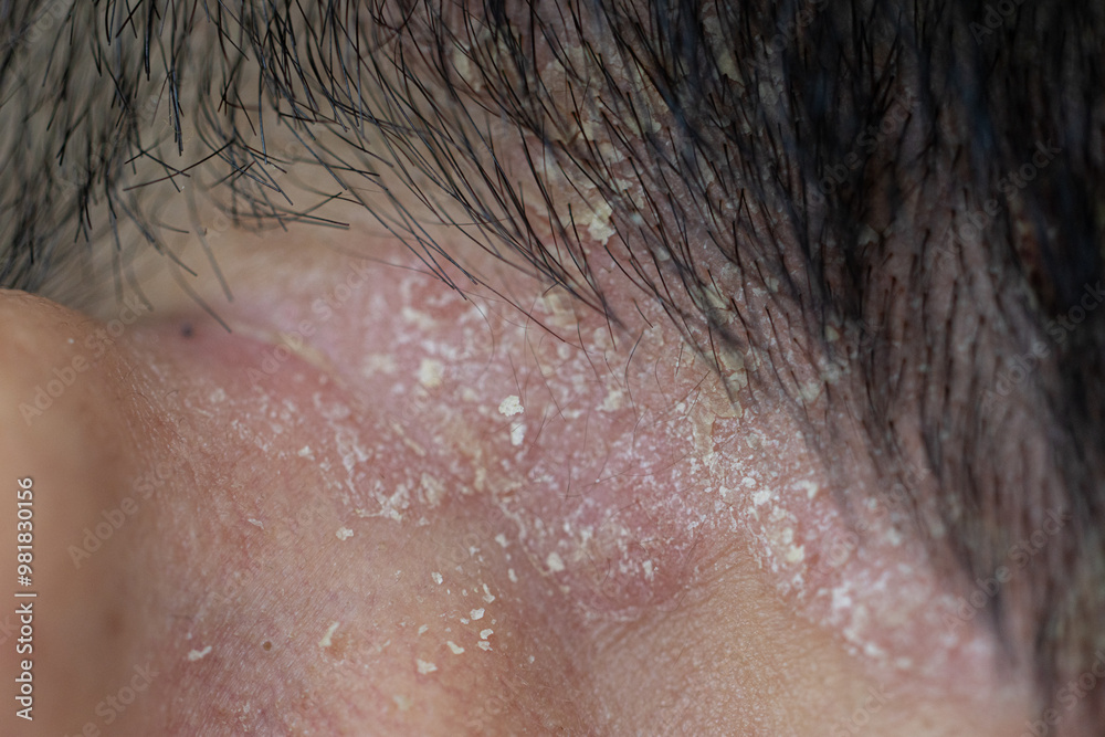 Scalp fungal infection that causes skin disease at the head, skin on ...