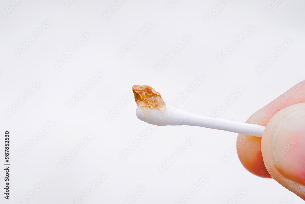 Hand holds cotton swab with extracted giant ear wax plug. Cerumen on ...