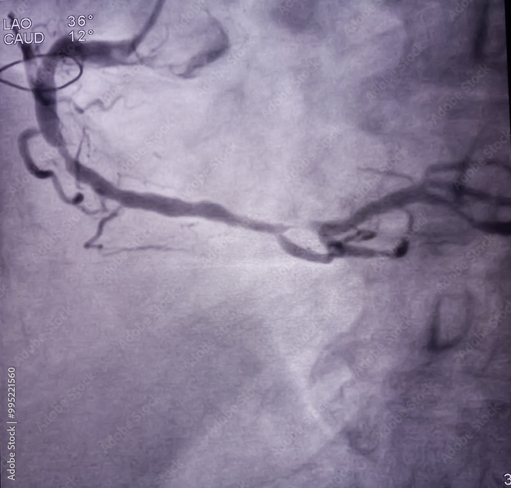 Coronary angiogram of right coronary artery during cardiac ...