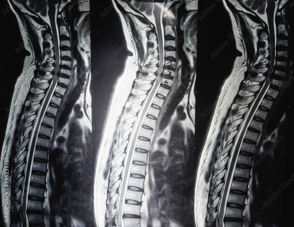 Poster MRI scan of cervical spine (C-spine) : Nerve root compression ...