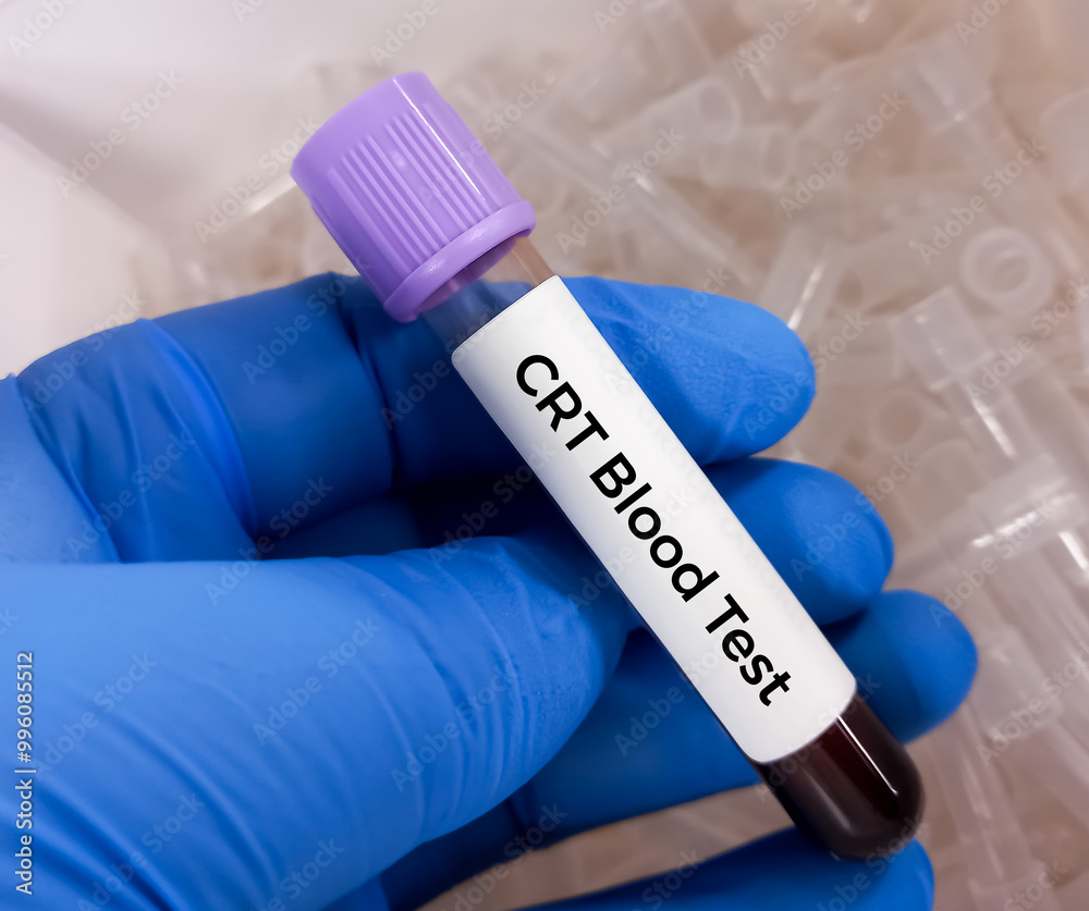 Blood sample for clot retraction test, to measures the time taken for a ...