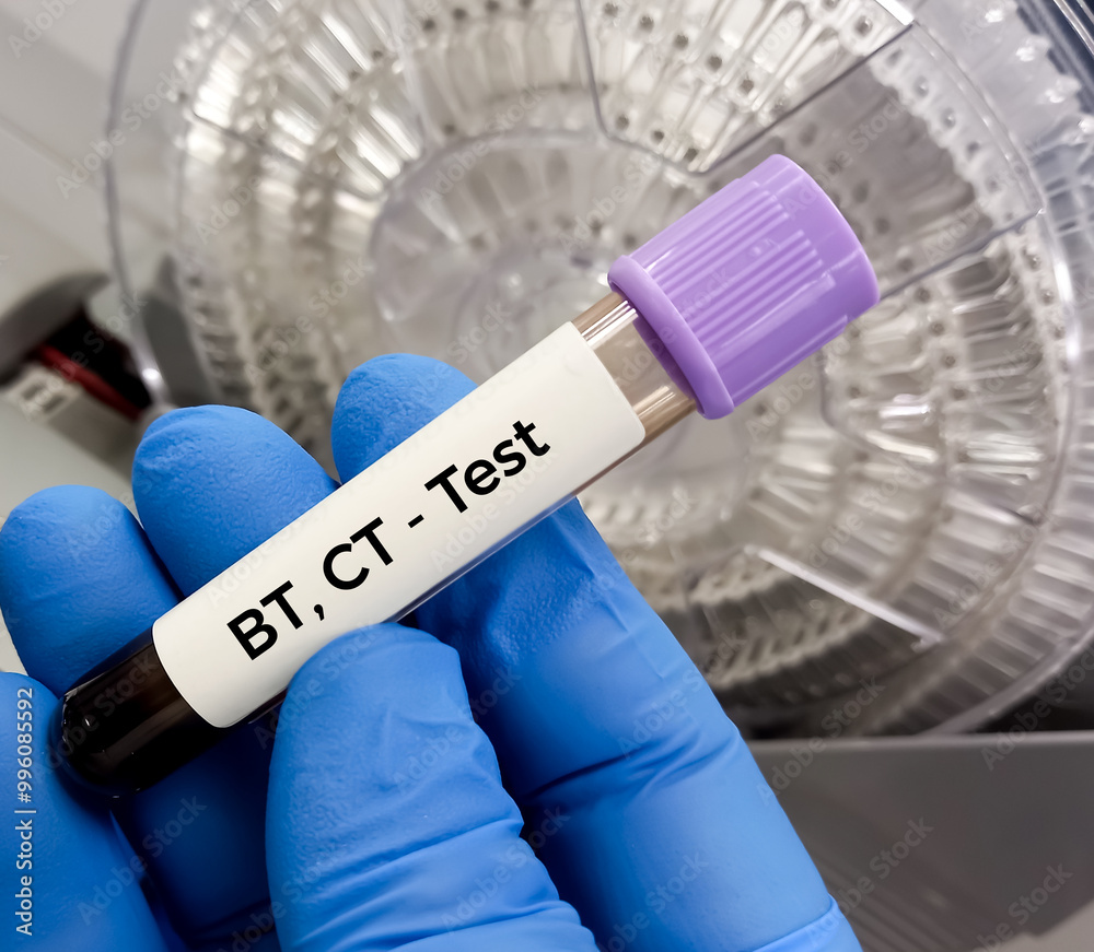 Blood test sample for BT, CT (bleeding time and clotting time) test ...