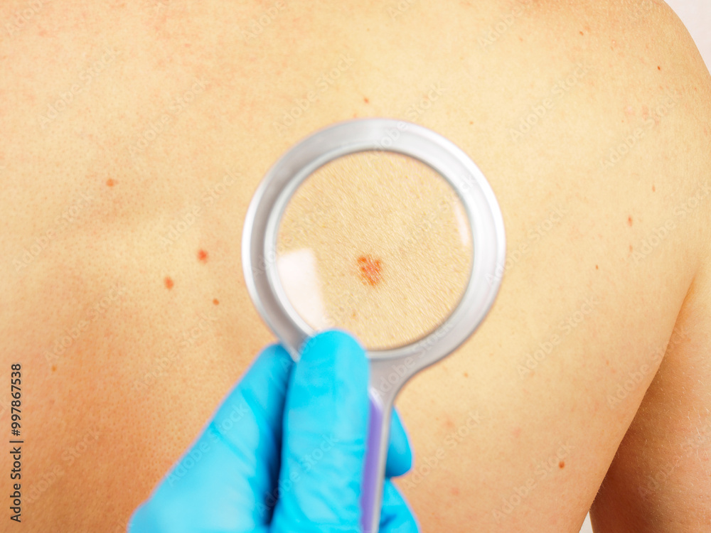 Skin examination by a dermatologist: examination of moles and ...