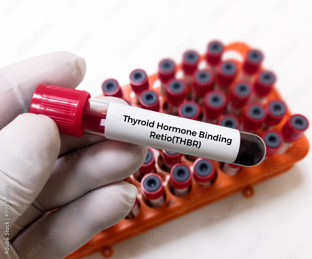 Blood sample for Thyroid Hormone–Binding Ratio (THBR) or THBI or T3 ...