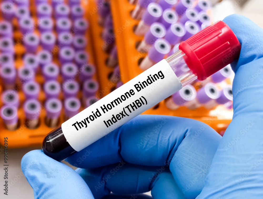 Blood sample for Thyroid Hormone–Binding Ratio (THBR) or THBI or T3 ...