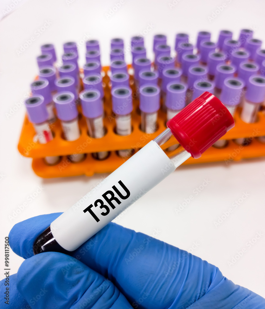 Blood sample for T3 resin uptake(T3RU) test. Thyroid function tests to ...