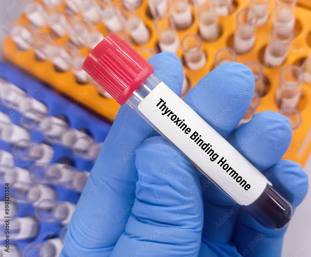 Blood sample for TBG (Thyroxine-binding globulin) test. Thyroid ...