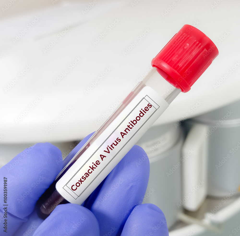Blood sample for Hand foot and mouth disease (HFMD) test. It is a ...