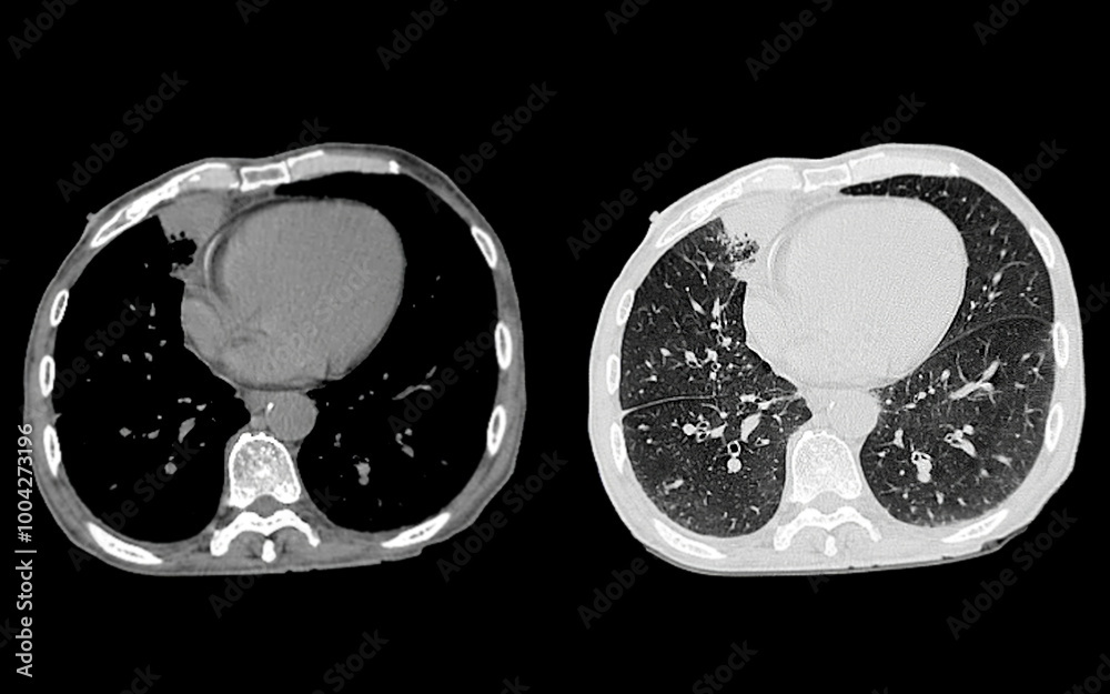 A CT scan of the chest showing multiple cross-sectional views ...