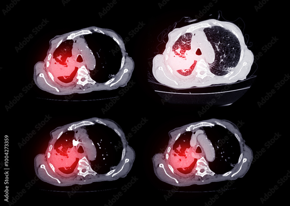 A CT scan of the chest showing multiple cross-sectional views ...