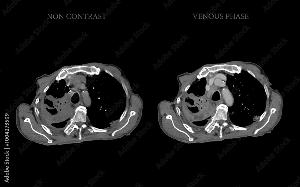 A CT scan of the chest showing multiple cross-sectional views ...