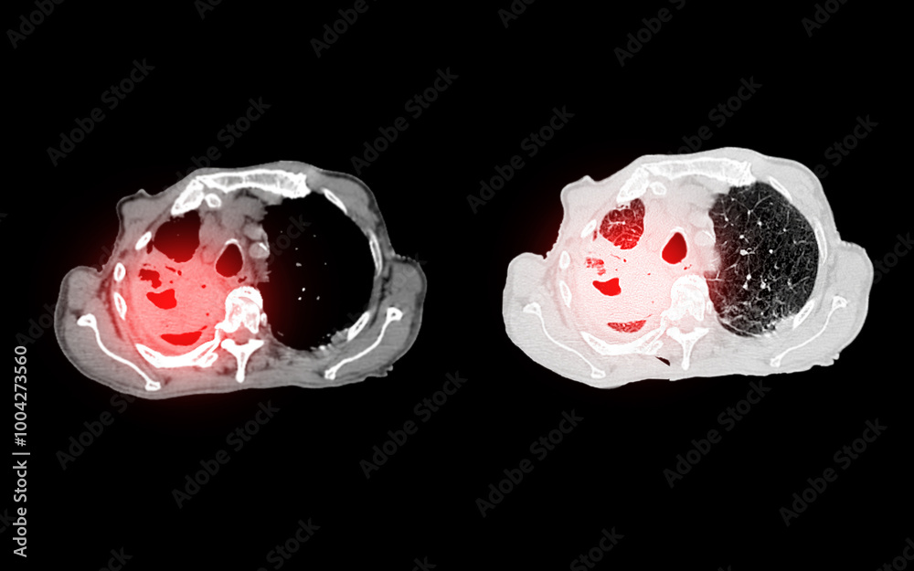 A CT scan of the chest showing multiple cross-sectional views ...