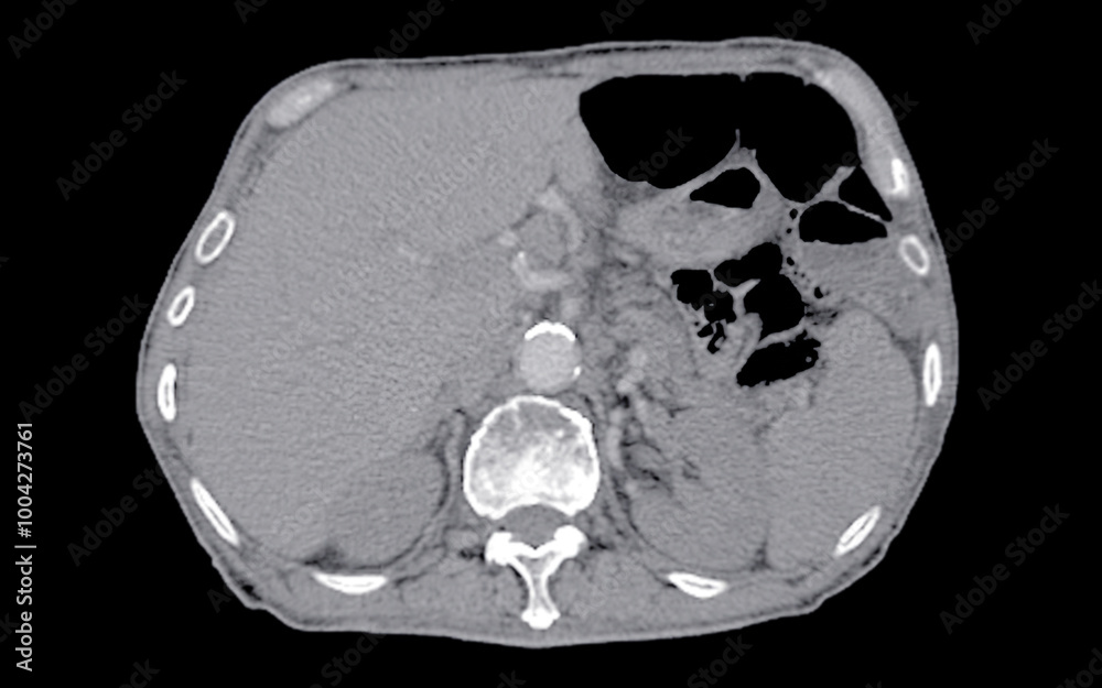 A normal CT scan of the upper abdomen, showing clear and healthy cross ...