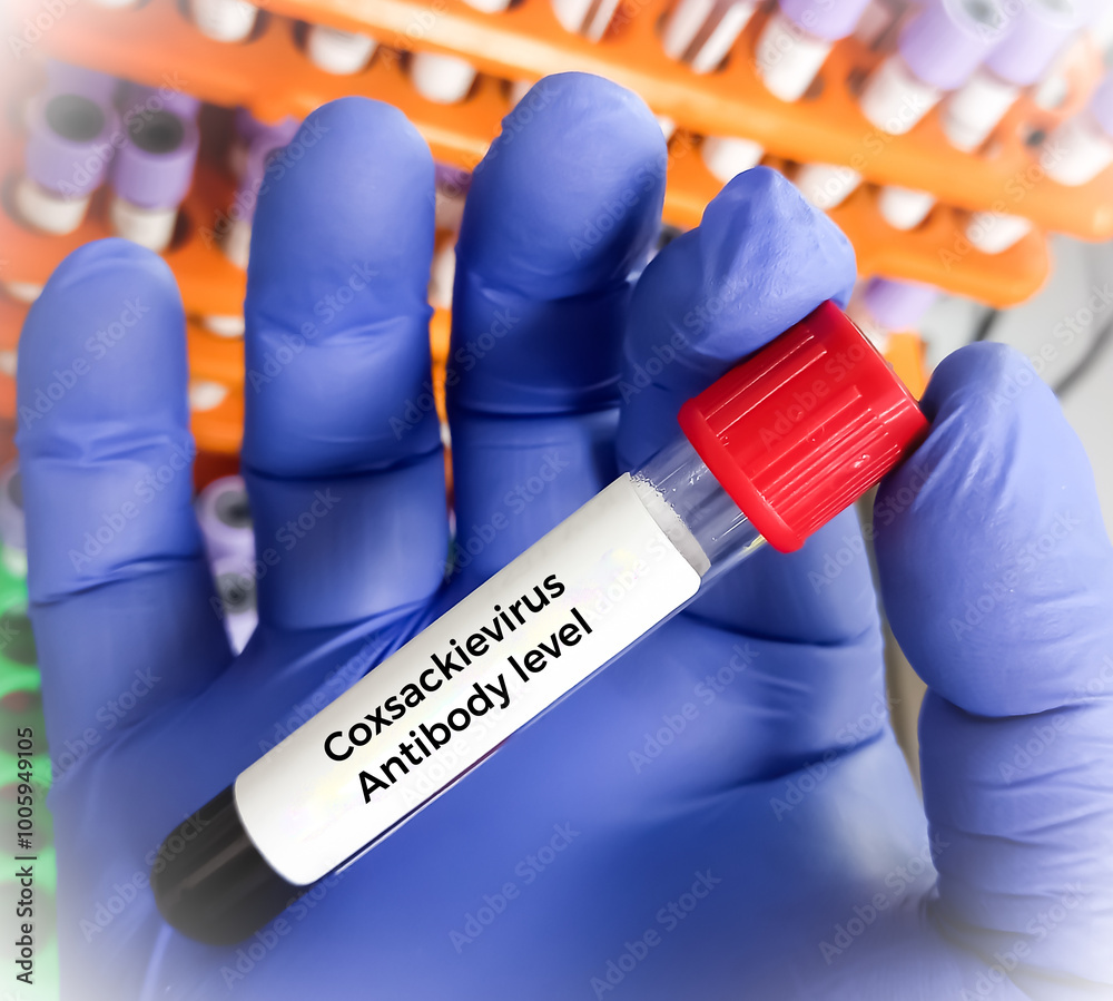 Blood sample for Hand foot and mouth disease (HFMD) test. It is a ...