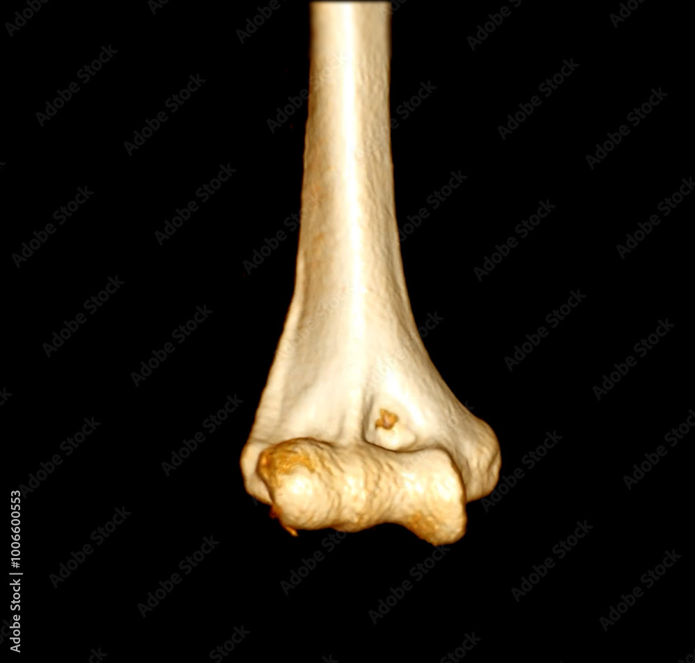 A 3D CT scan of the elbow joint showing normal bone structure and ...
