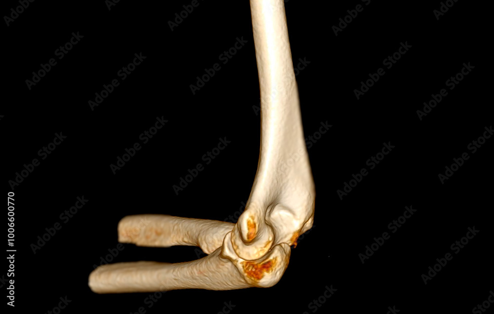 A 3D CT scan of the elbow joint showing normal bone structure and ...