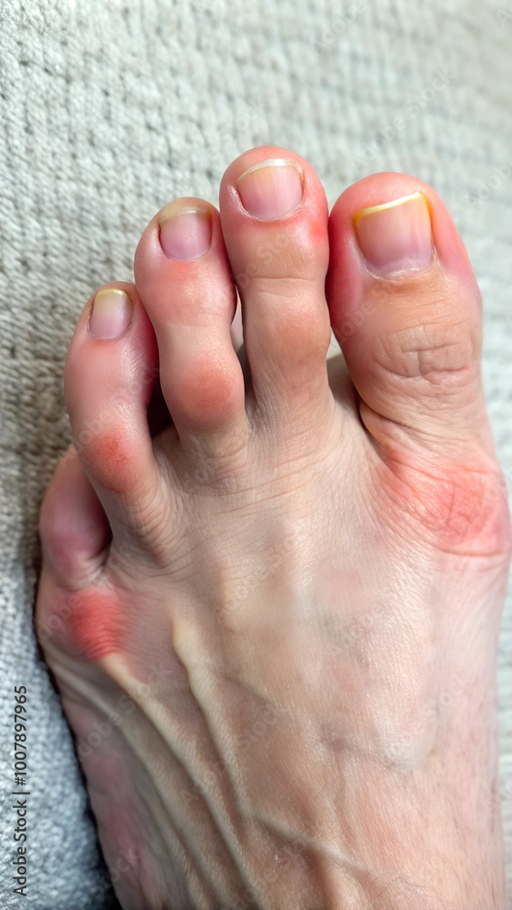 Phalangeal Fracture: The Toe Pain and Discoloration - A person holding ...
