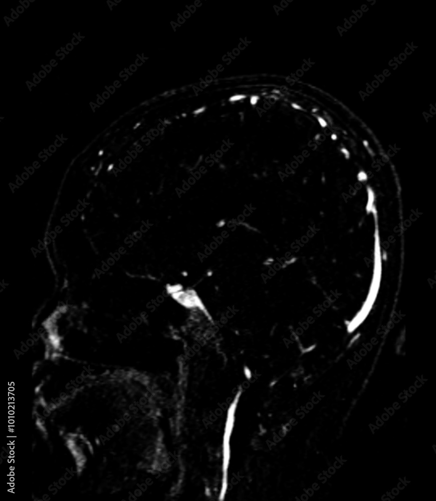 A normal MRV brain scan showing clear and healthy venous structures ...