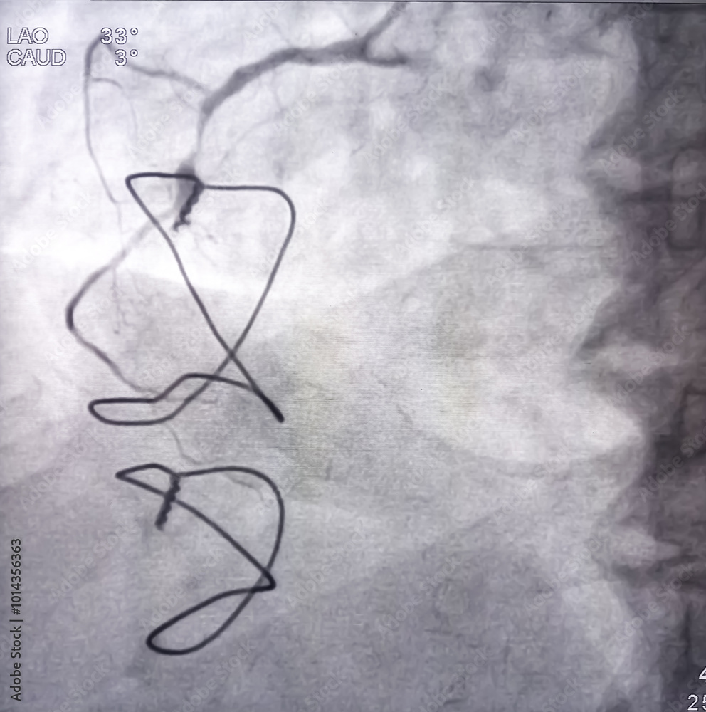 Coronary angiogram of right coronary artery during cardiac ...