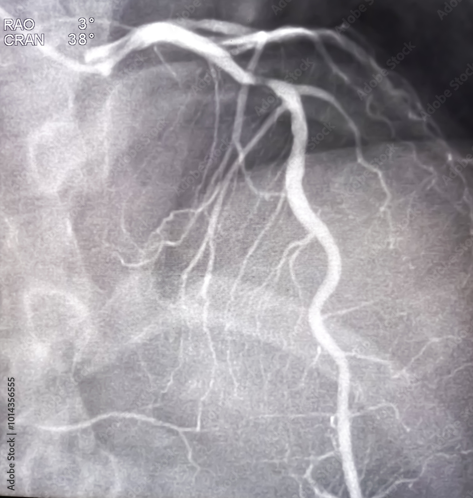 Coronary angiogram of left coronary artery during cardiac ...