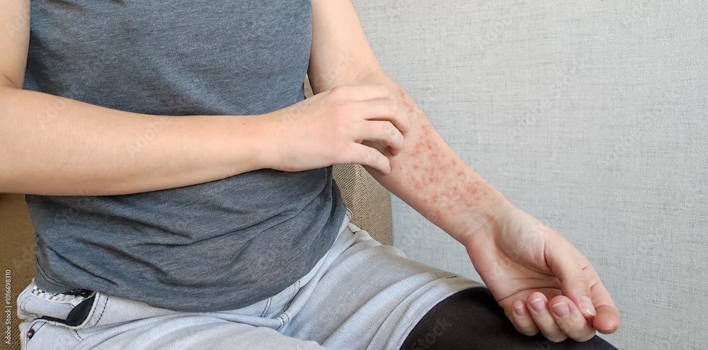 Woman with rash on her hands sitting on bed. Marburg virus, fever, red ...