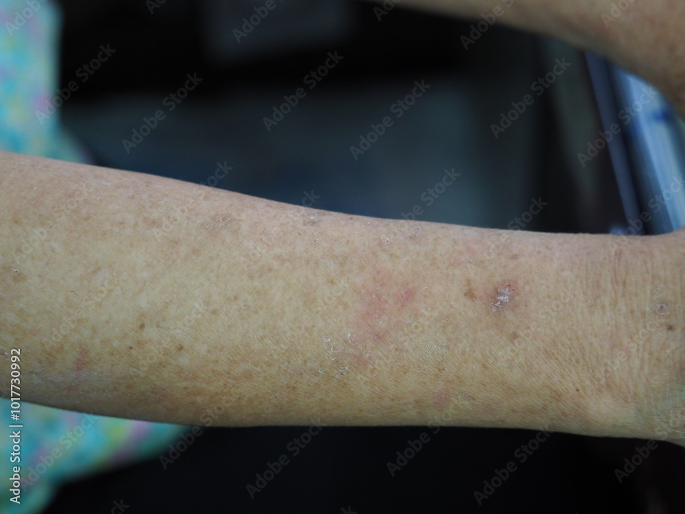 Close-up of Age Spots on Skin: A detailed view of age spots on an ...