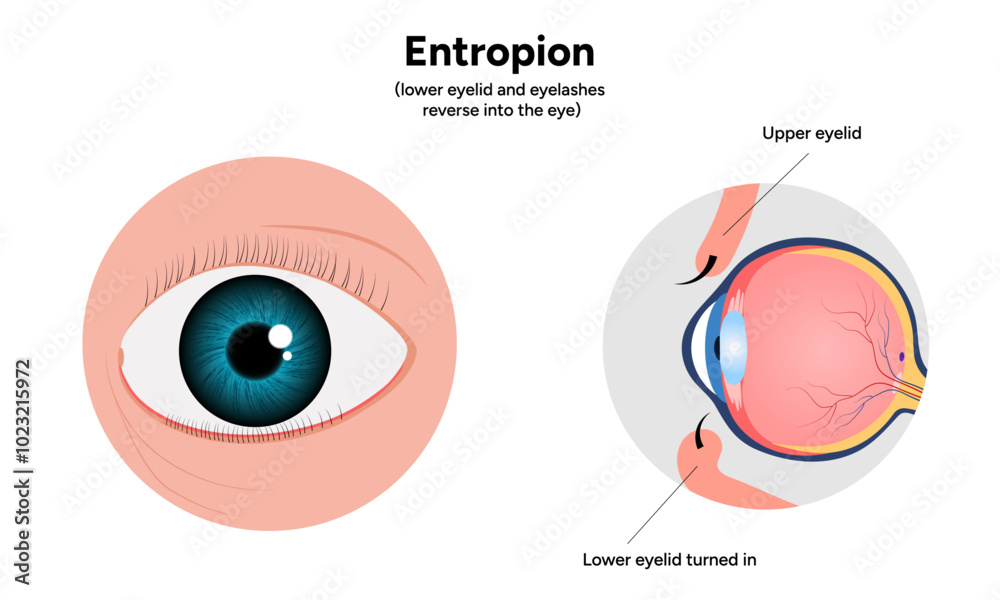 Entropion eye ophthalmology problem diagram and infographic Stock ...