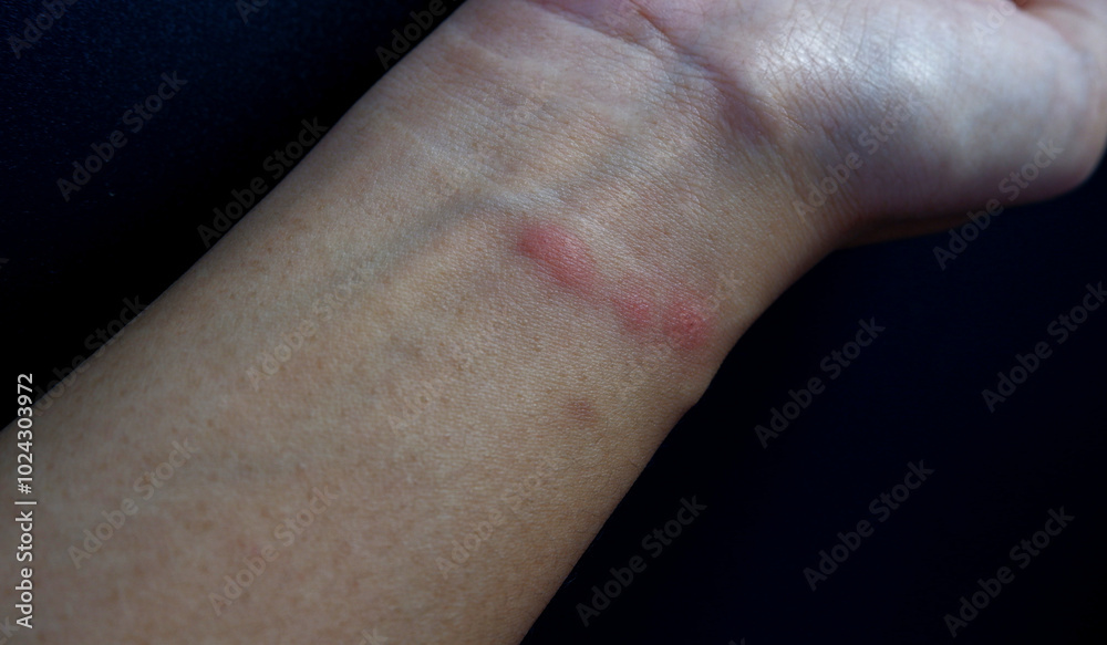 Ant bites on the wrist with a black background. Close-up red marks on ...