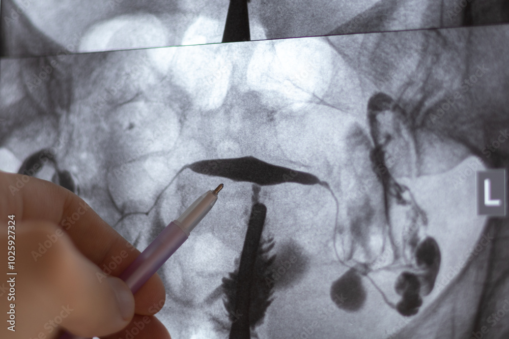 Doctor examining X-ray image of Hysterosalpingography (HSG). MRI with ...