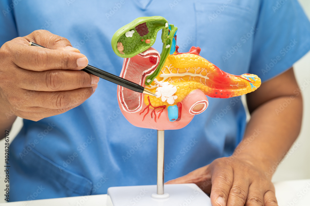 Poster Pancreatitis, pancreatic cancer, Asian doctor with pancreas ...